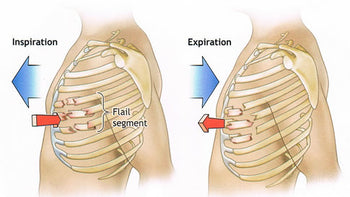 What Is A Flail Chest? – Train Your Probie